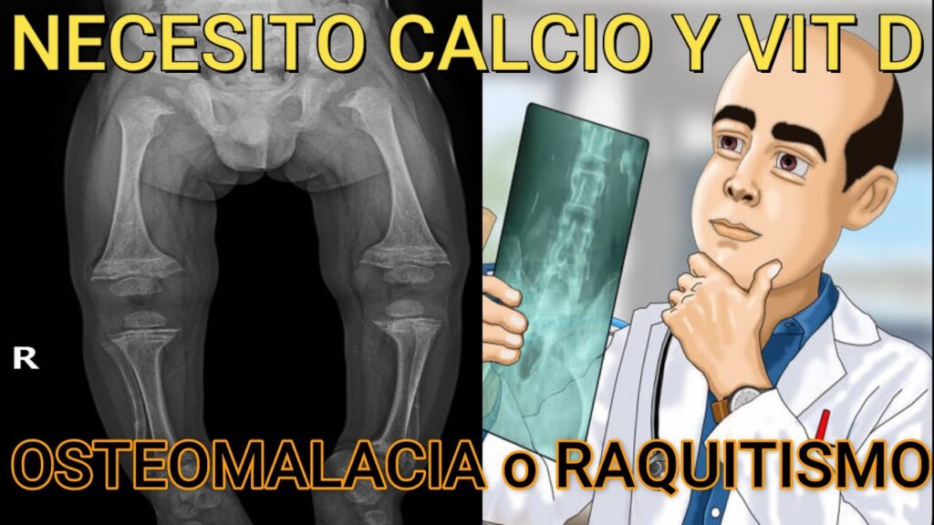Osteomalacia: causas, síntomas y tratamientos explicados | Enfermedades